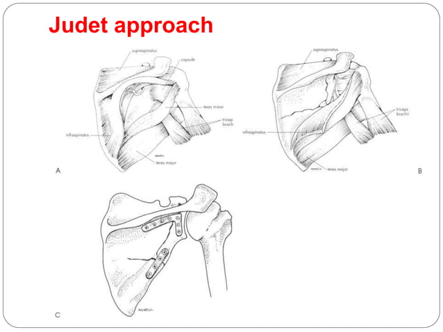 Scapula fracture diagnosis and management | PPTX