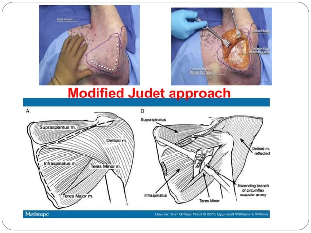 Scapula fracture diagnosis and management | PPTX