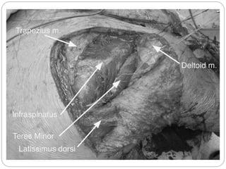 Scapula fracture diagnosis and management | PPTX
