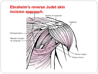 Scapula fracture diagnosis and management | PPTX