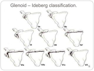 Scapula fracture diagnosis and management | PPT