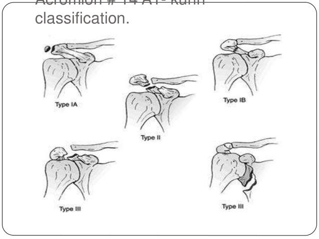 Scapula Classification Fractures Fracture Scapular Body Neck Ct ...