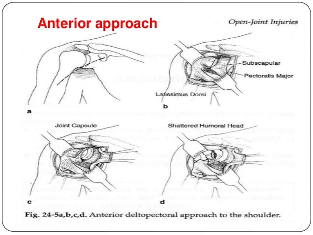 Scapula fracture diagnosis and management
