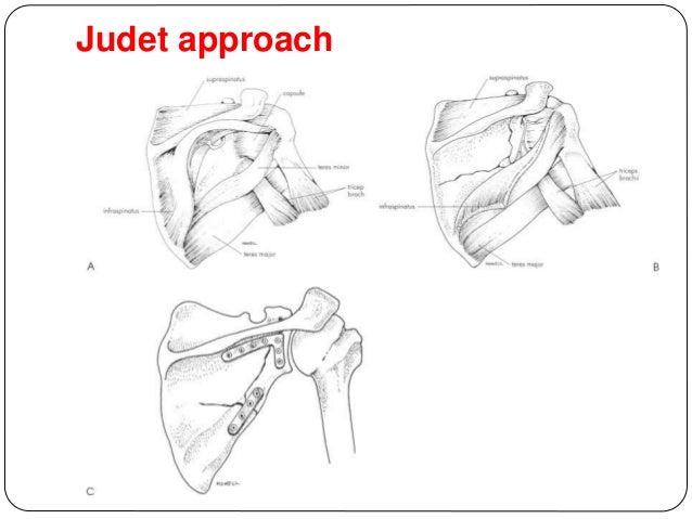 Scapula fracture diagnosis and management
