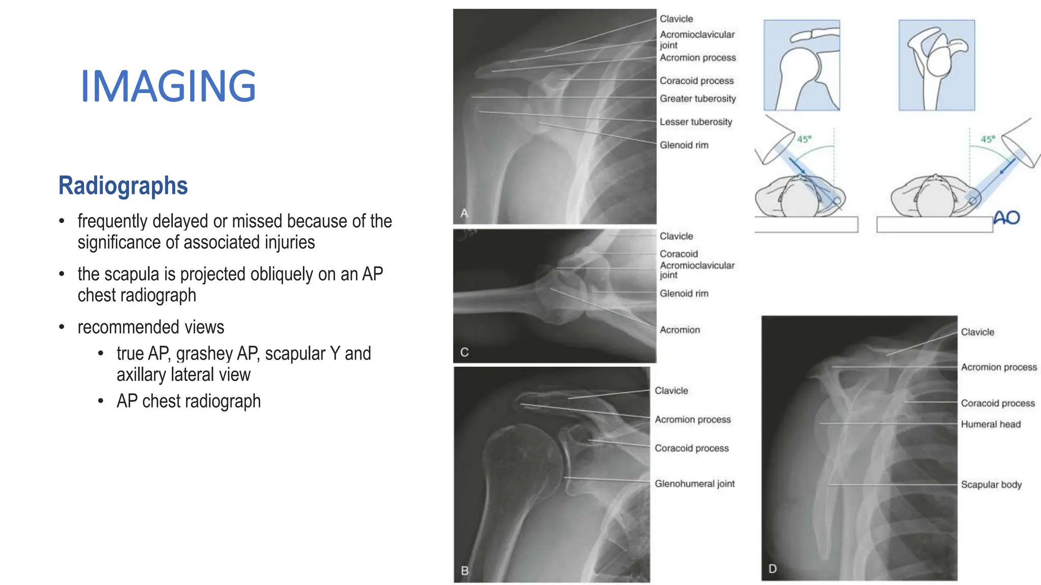 A review of Scapula Fractures with it's managment.pptx