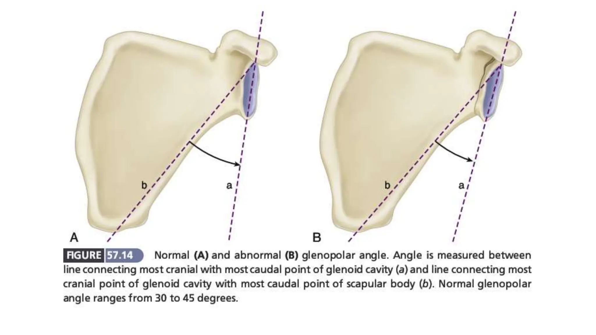 A review of Scapula Fractures with it's managment.pptx