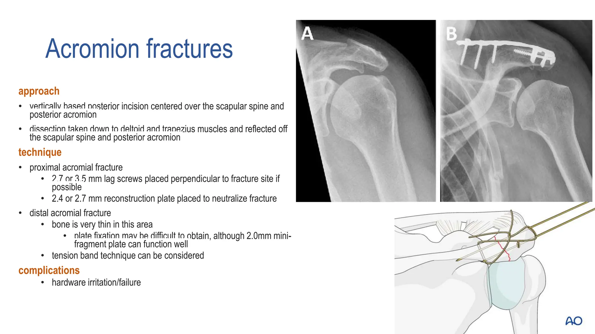 A review of Scapula Fractures with it's managment.pptx