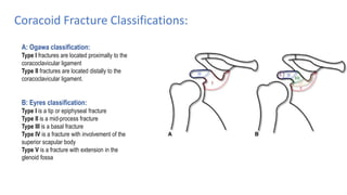 A review of Scapula Fractures with it's managment.pptx