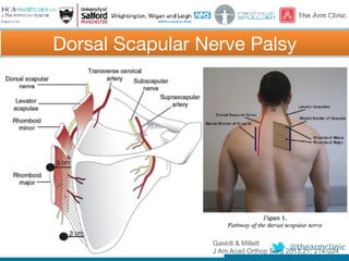 Dorsal Scapular Nerve Entrapment