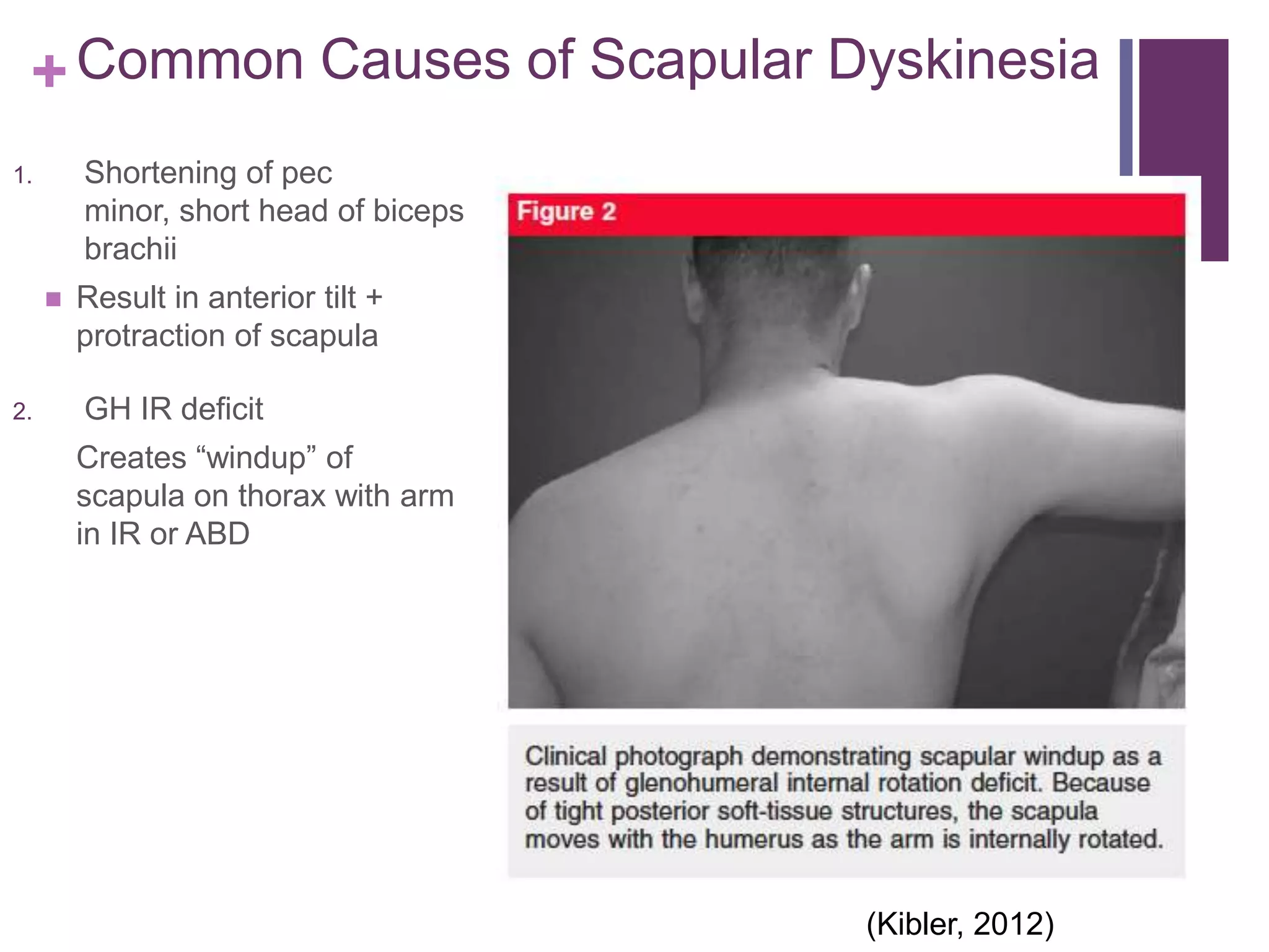 Scapular dyskinesia and its relationship to rotator cuff impingement ...