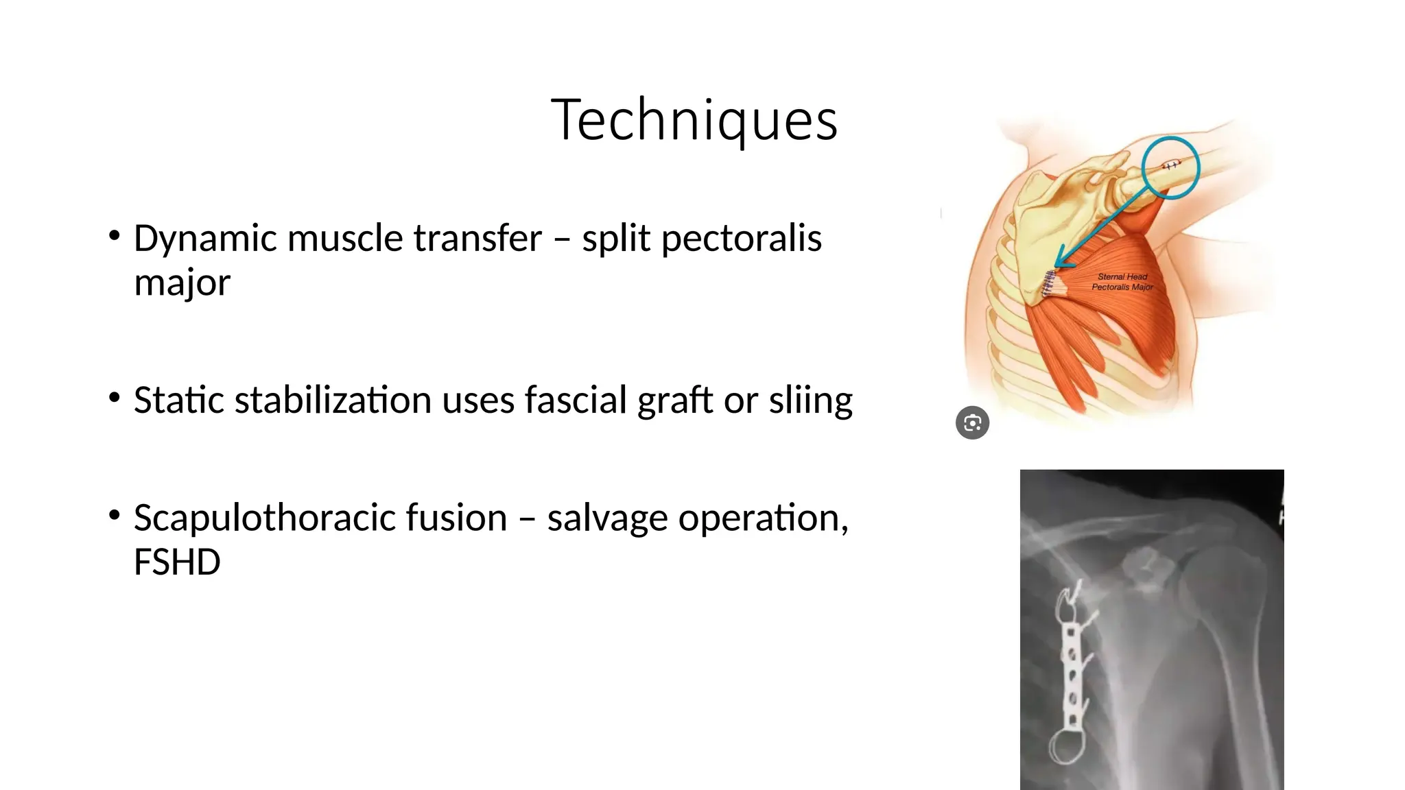 SCAPULAR DYSKINESIS types and management.pptx