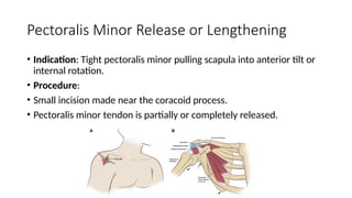 Comprehensive Overview of Scapular Dyskinesis: Causes, Biomechanics ...