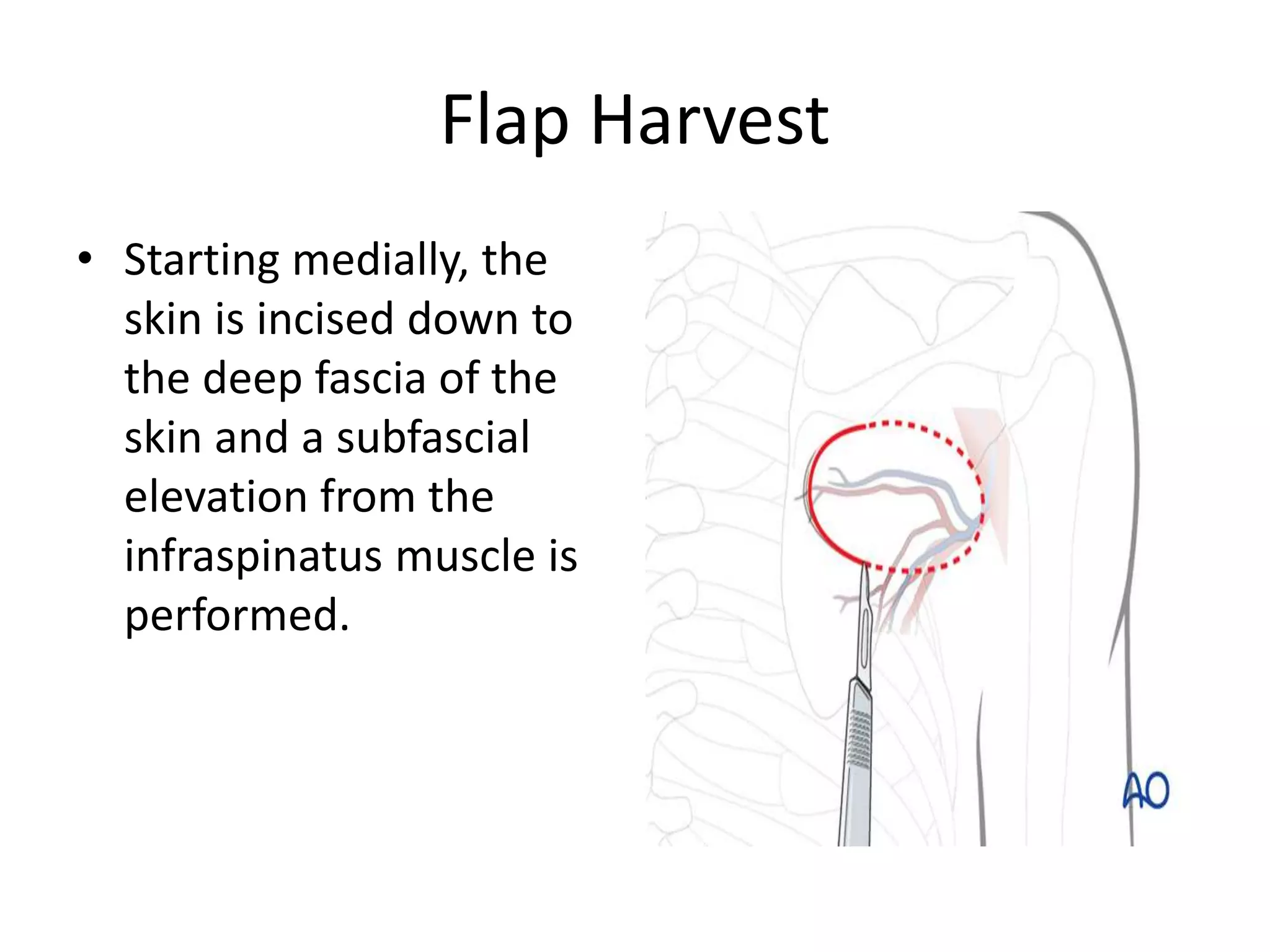 Scapular flap | PPT