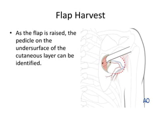 Scapular flap | PPT