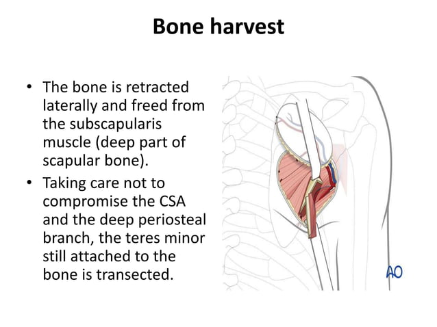 Scapular flap | PPT