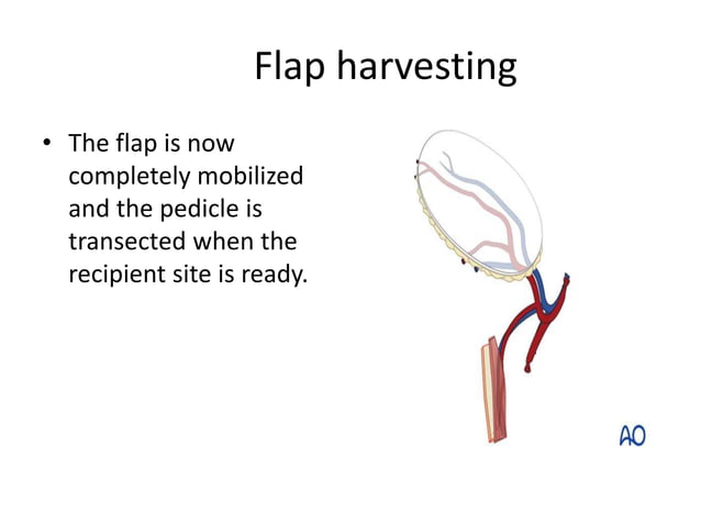 Scapular flap | PPT