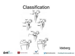 Scapular fractures | PPTX | Death, Injury, or Military Conflict ...