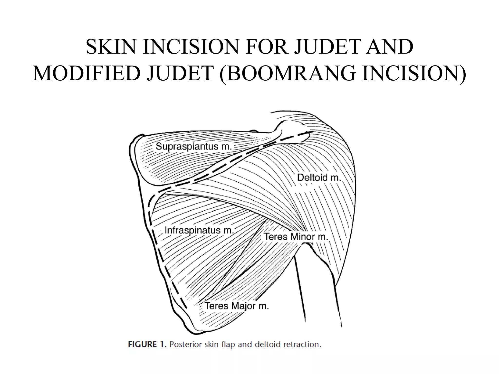Scapula surgical approaches ppt | PPTX