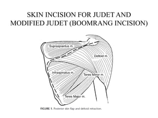 Scapula surgical approaches ppt | PPTX
