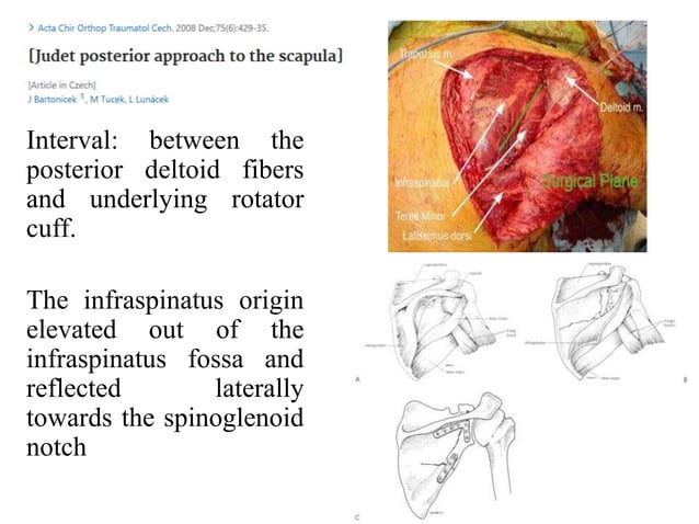 Scapula surgical approaches ppt | PPTX | Death, Injury, or Military ...