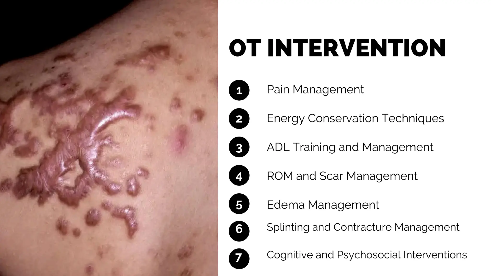 Burn and Scar management in occupational therapy | PDF
