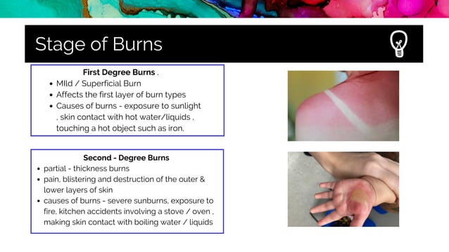 Burn and Scar management in occupational therapy | PDF