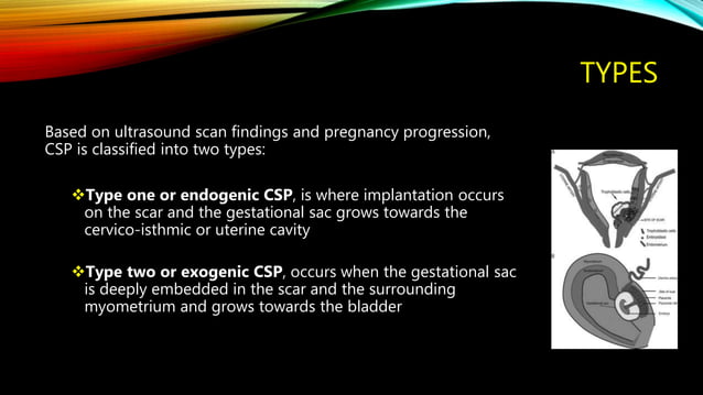 SCAR ECTOPIC | PPTX | Pregnancy | Reproductive Health
