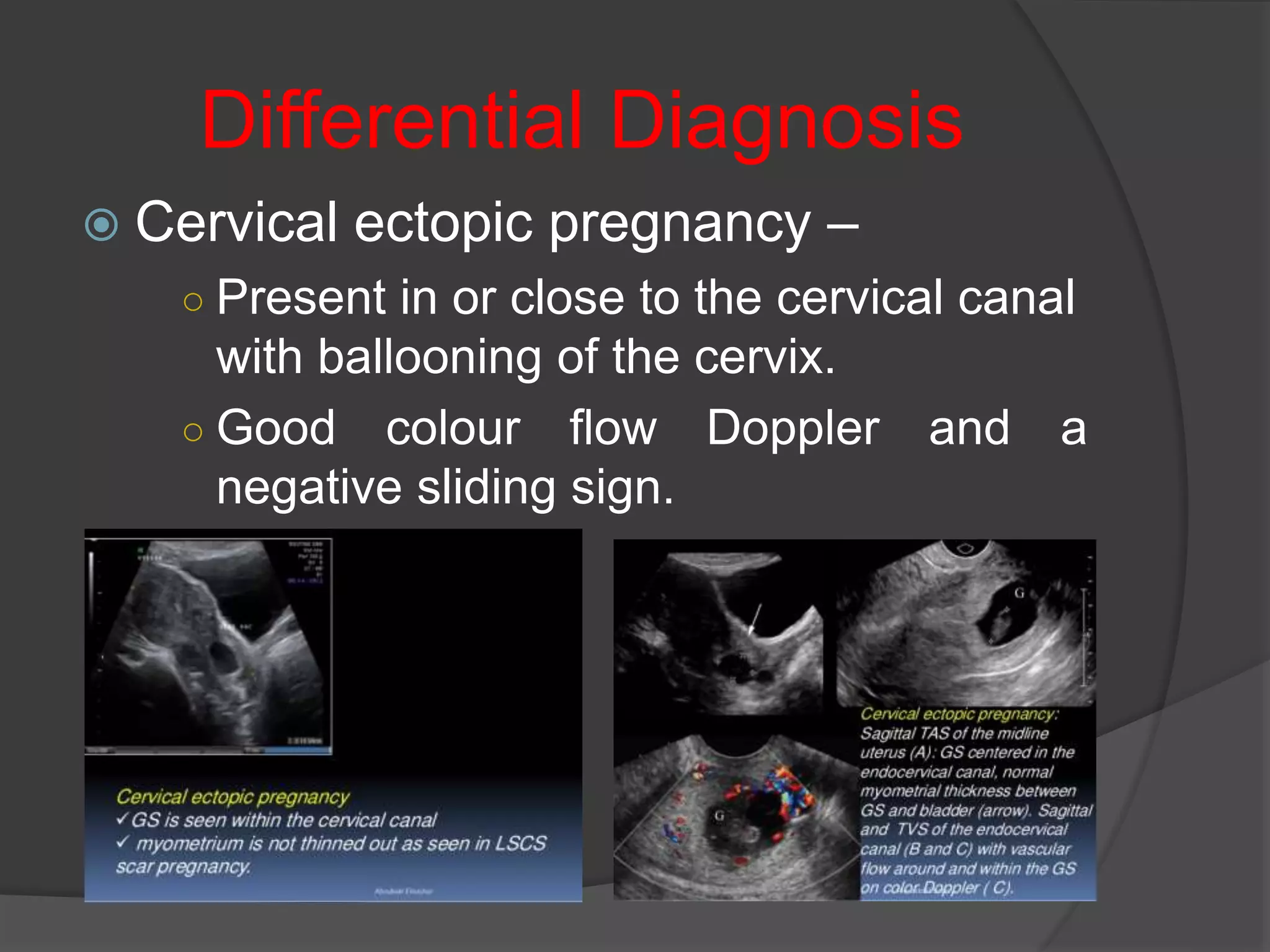 Scar ectopic pregnancy | PPTX | Pregnancy | Reproductive Health