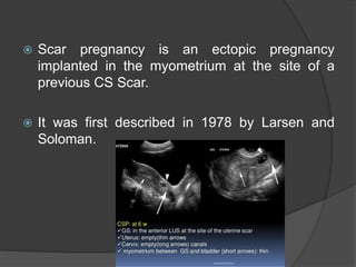Scar ectopic pregnancy | PPTX