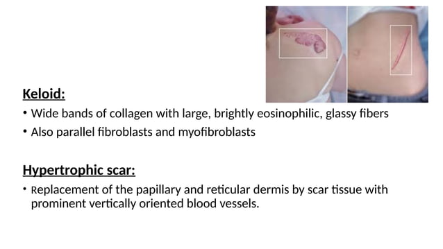 Presentation on Scar Formation in the process of wound healing | PPT