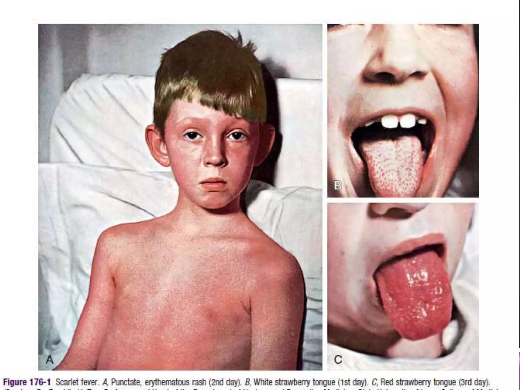 Scarlet fever ( infectious diseases ) | PPTX