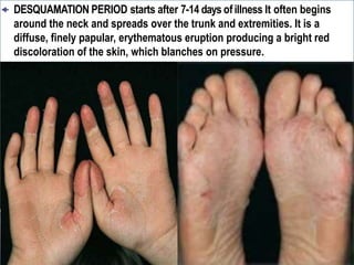 Scarlet fever ( infectious diseases ) | PPTX