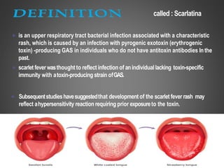 Scarlet fever ( infectious diseases ) | PPTX