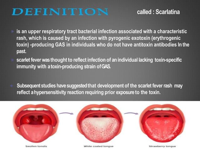 Scarlet fever ( infectious diseases ) | PPTX