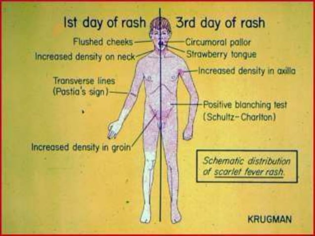 Scarlet fever ( infectious diseases )