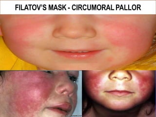 Scarlet fever ( infectious diseases ) | PPT