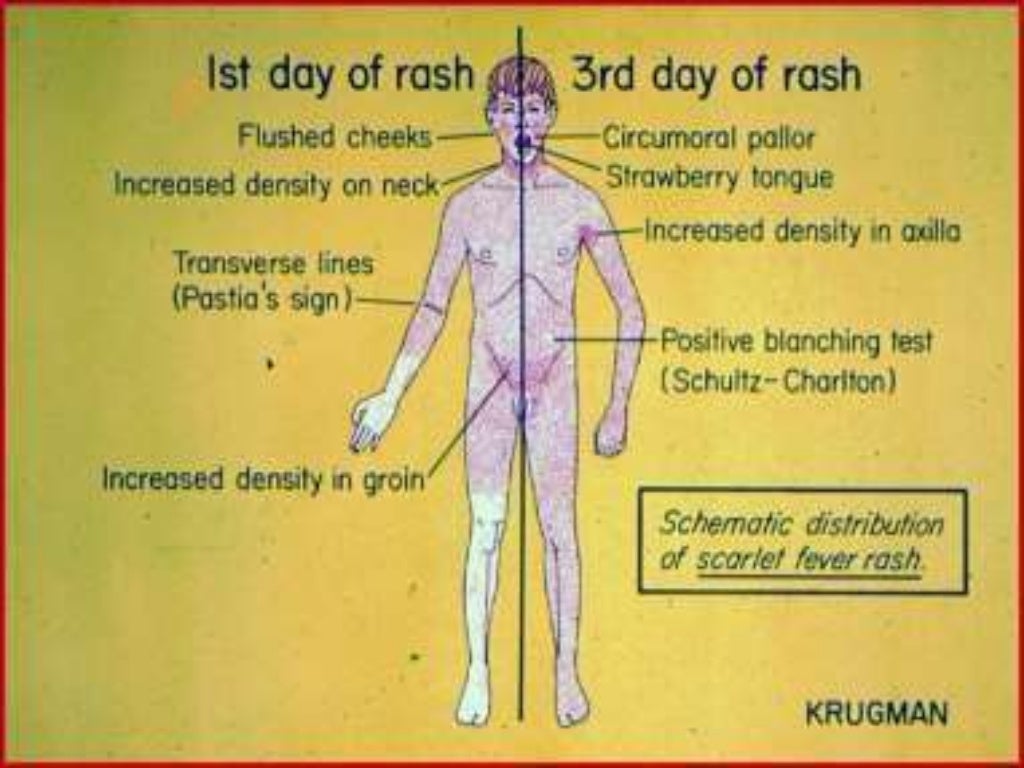 Scarlet fever ( infectious diseases )