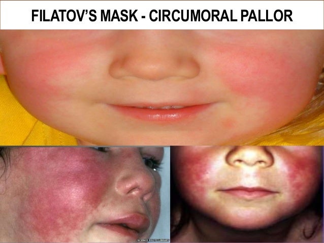 Scarlet fever ( infectious diseases )