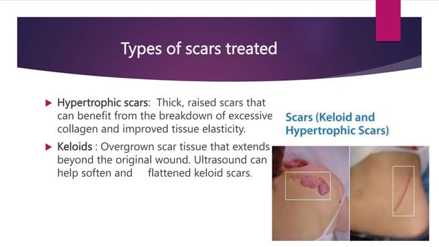 SCAR MANAGEMENT OF ULTRASOUND THERAPY.pptx