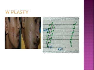 Scar revision | PPTX