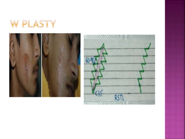 Scar revision | PPTX | Skin and Dermatology | Diseases and Conditions