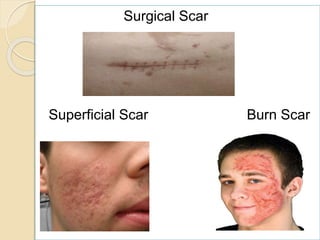 Scarring of wounds | PPT