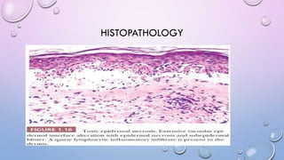 SEVERE CUTANEOUS ADVERSE REACTION TO DRUGS | PDF | Skin and Dermatology ...