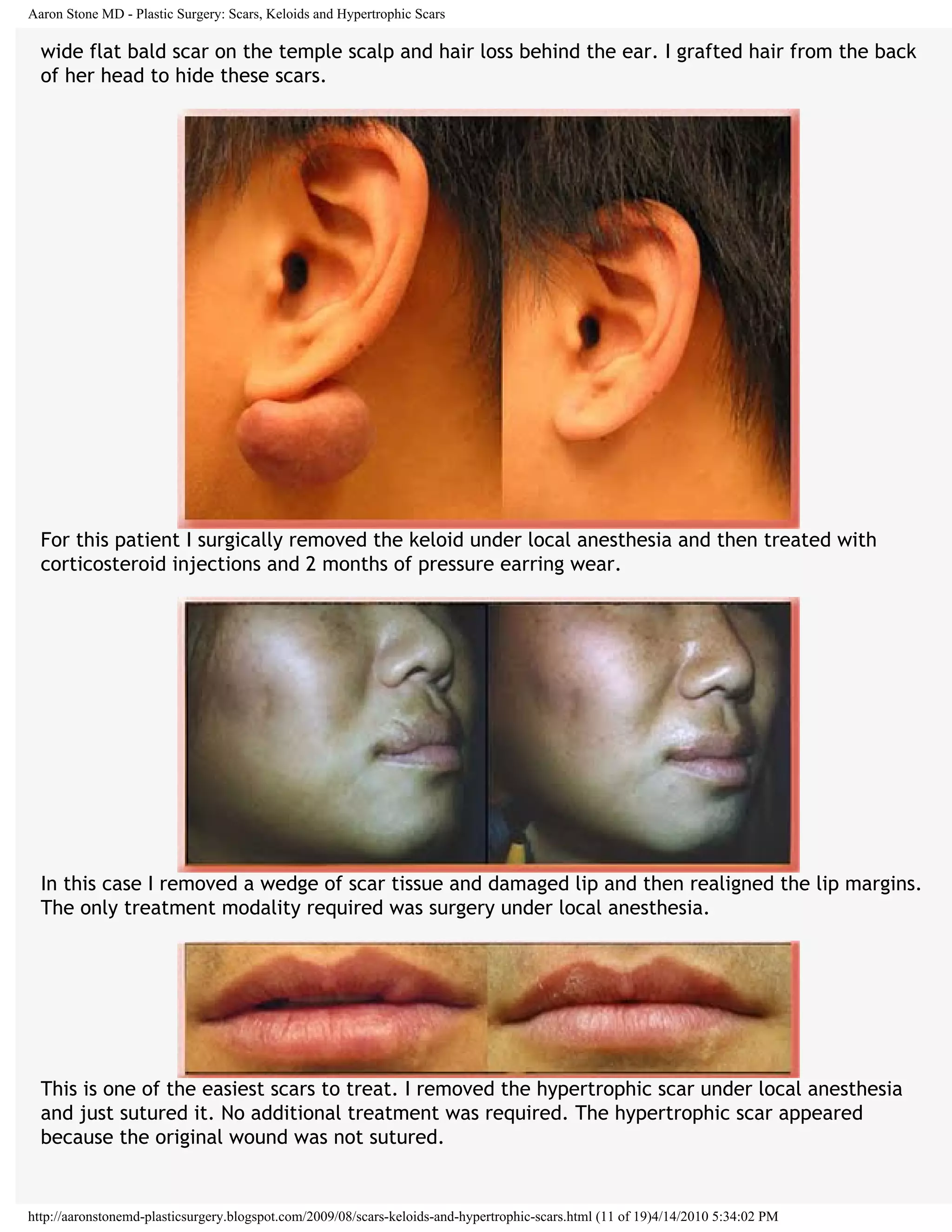 Scars keloids and hypertrophic-scars | PDF