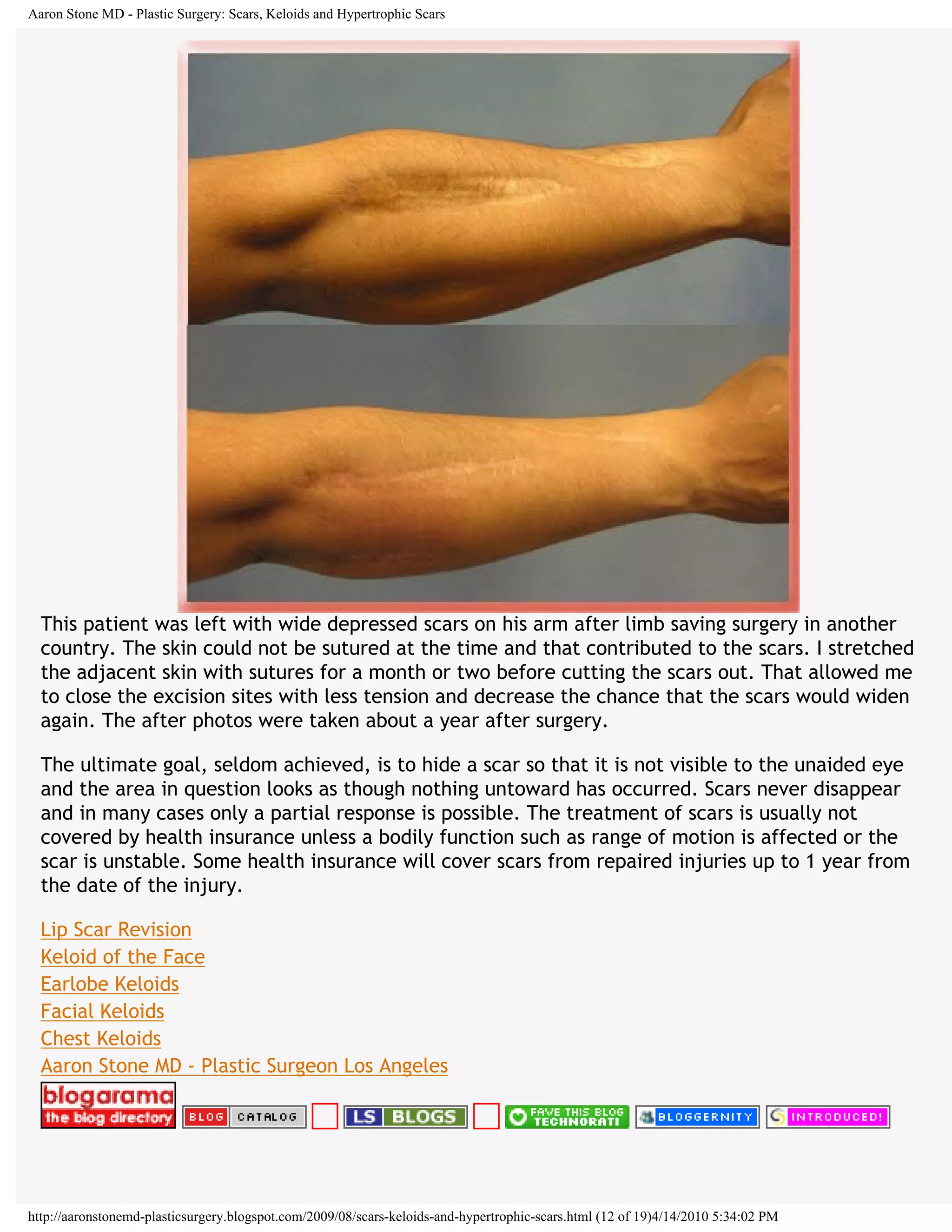 Scars keloids and hypertrophic-scars | PDF