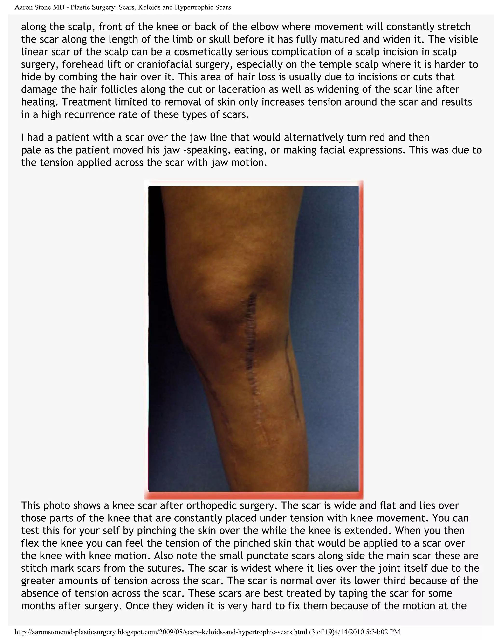 Scars keloids and hypertrophic-scars | PDF