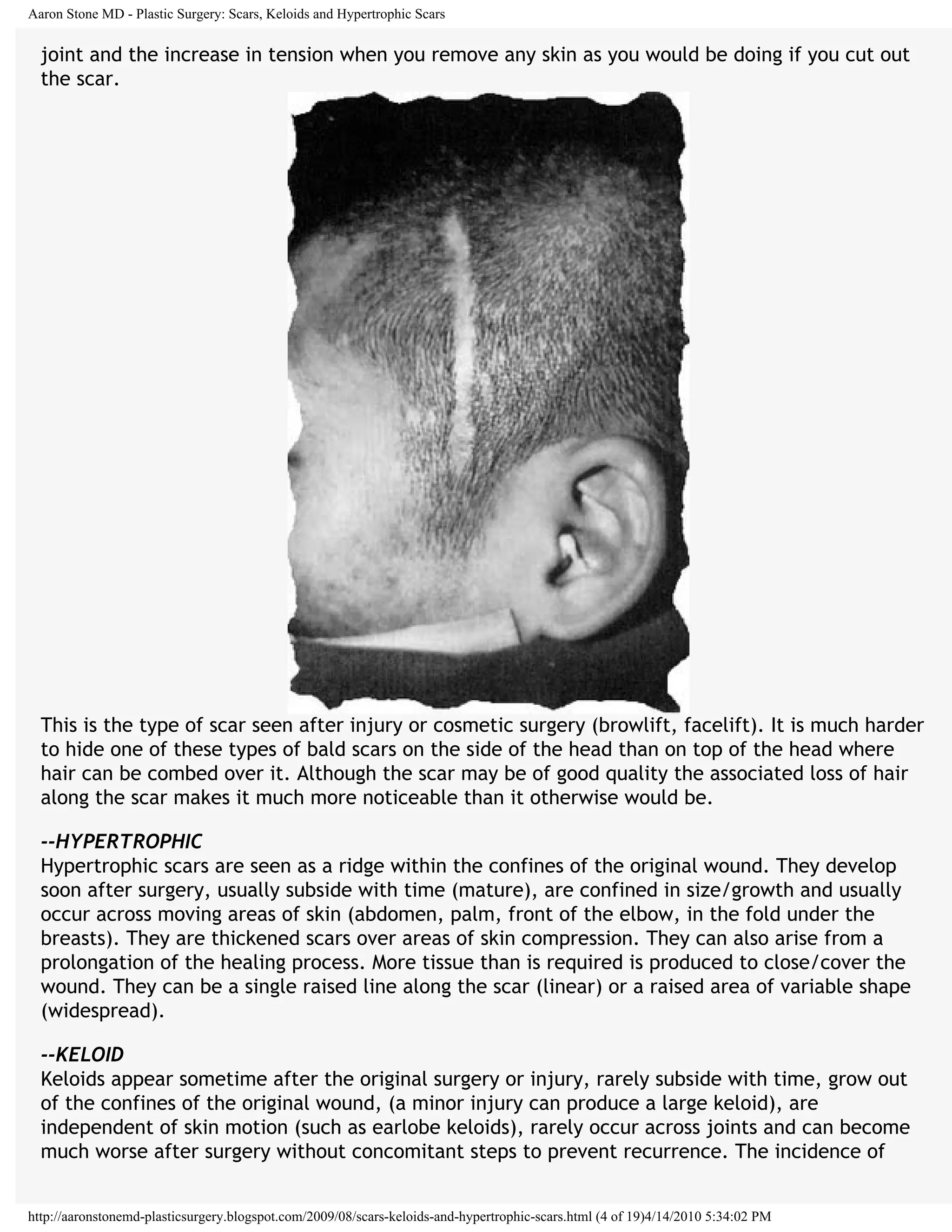 Scars keloids and hypertrophic-scars | PDF