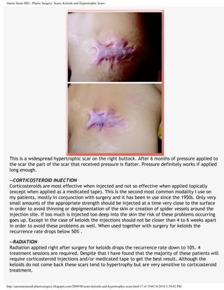 Scars keloids and hypertrophic-scars | PDF