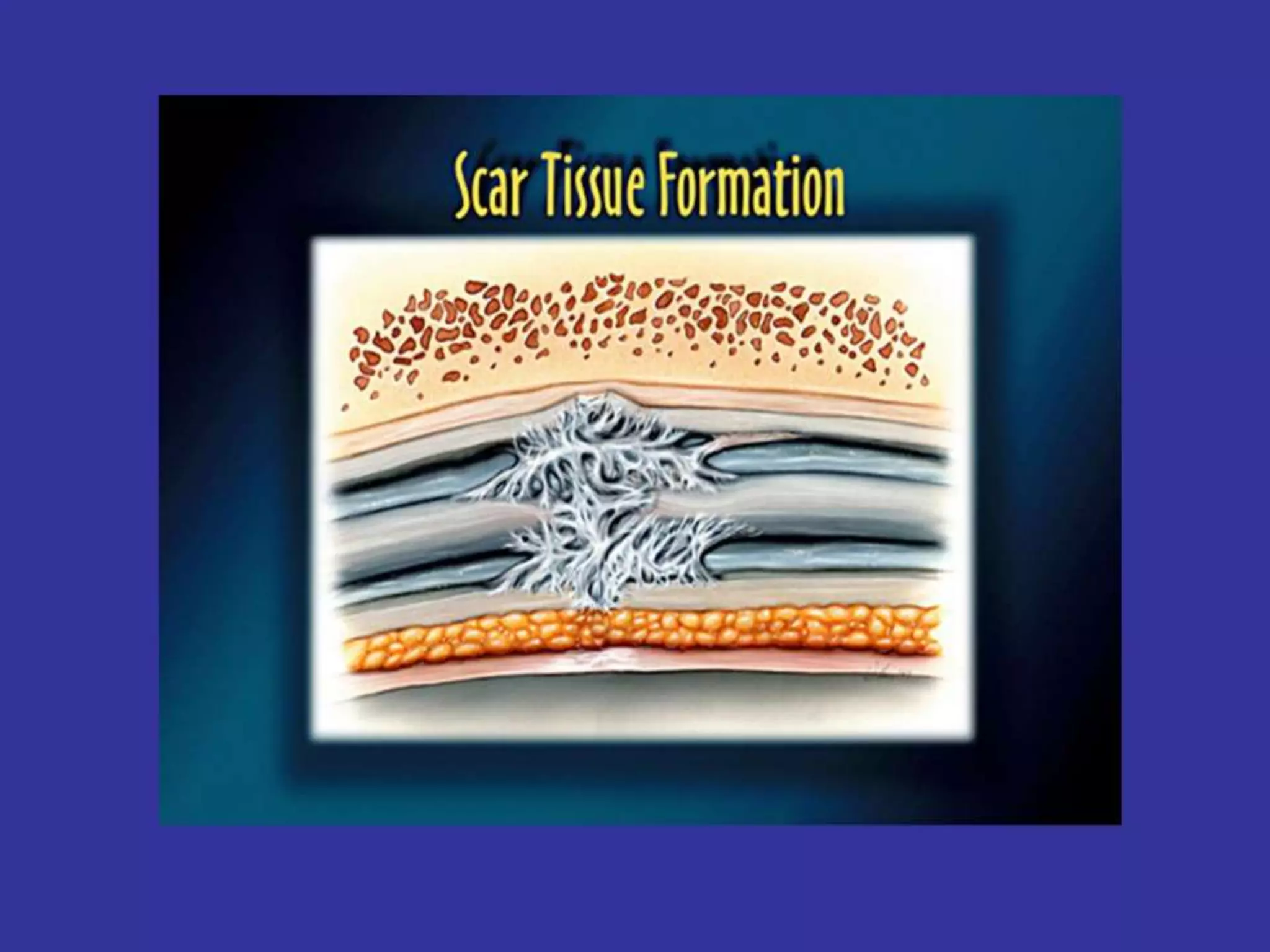 Scar Tissue Therapy Presentation Plastics | PPTX