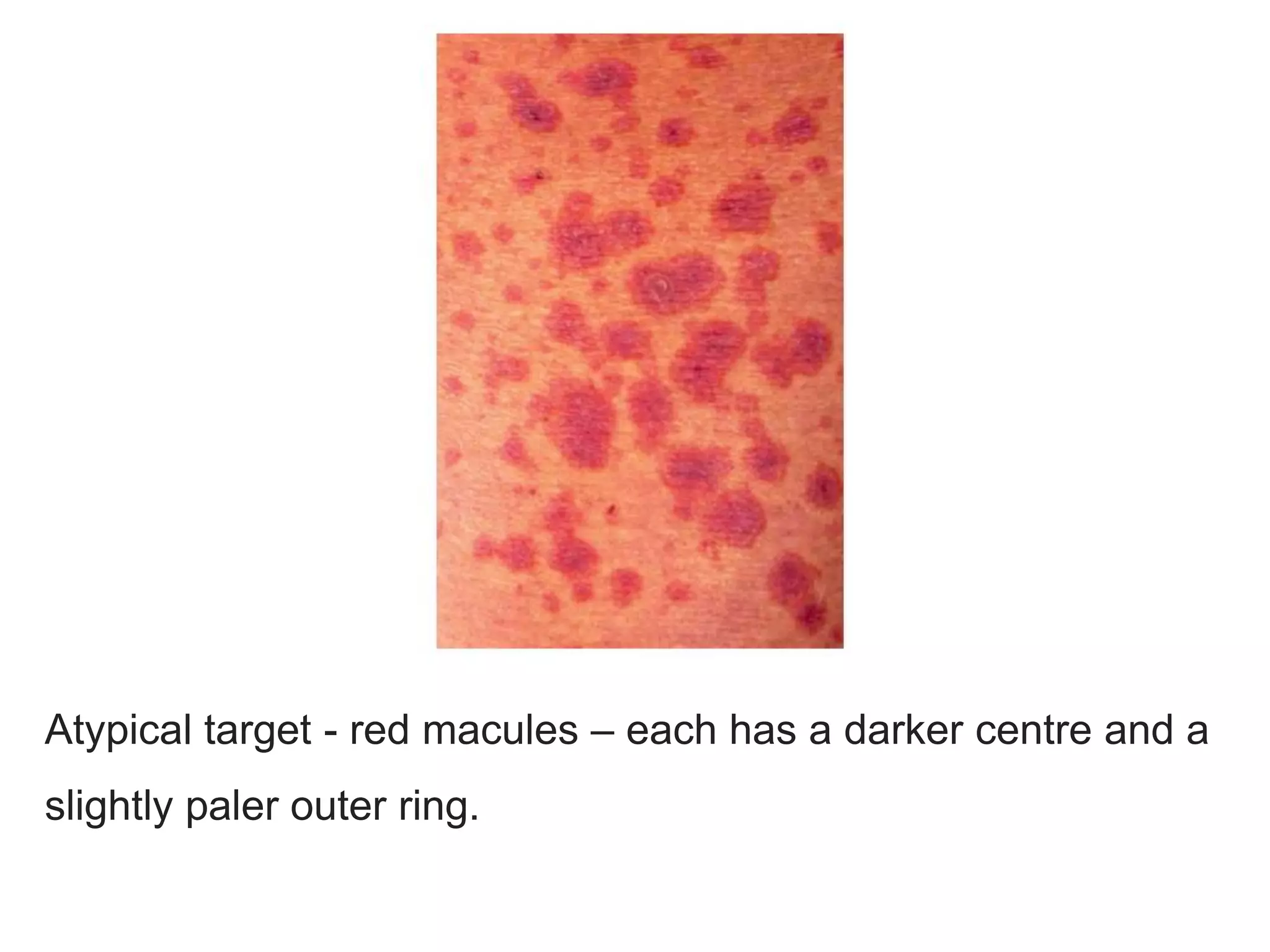 Severe Cutaneous Adverse Reactions to Drugs | PPTX